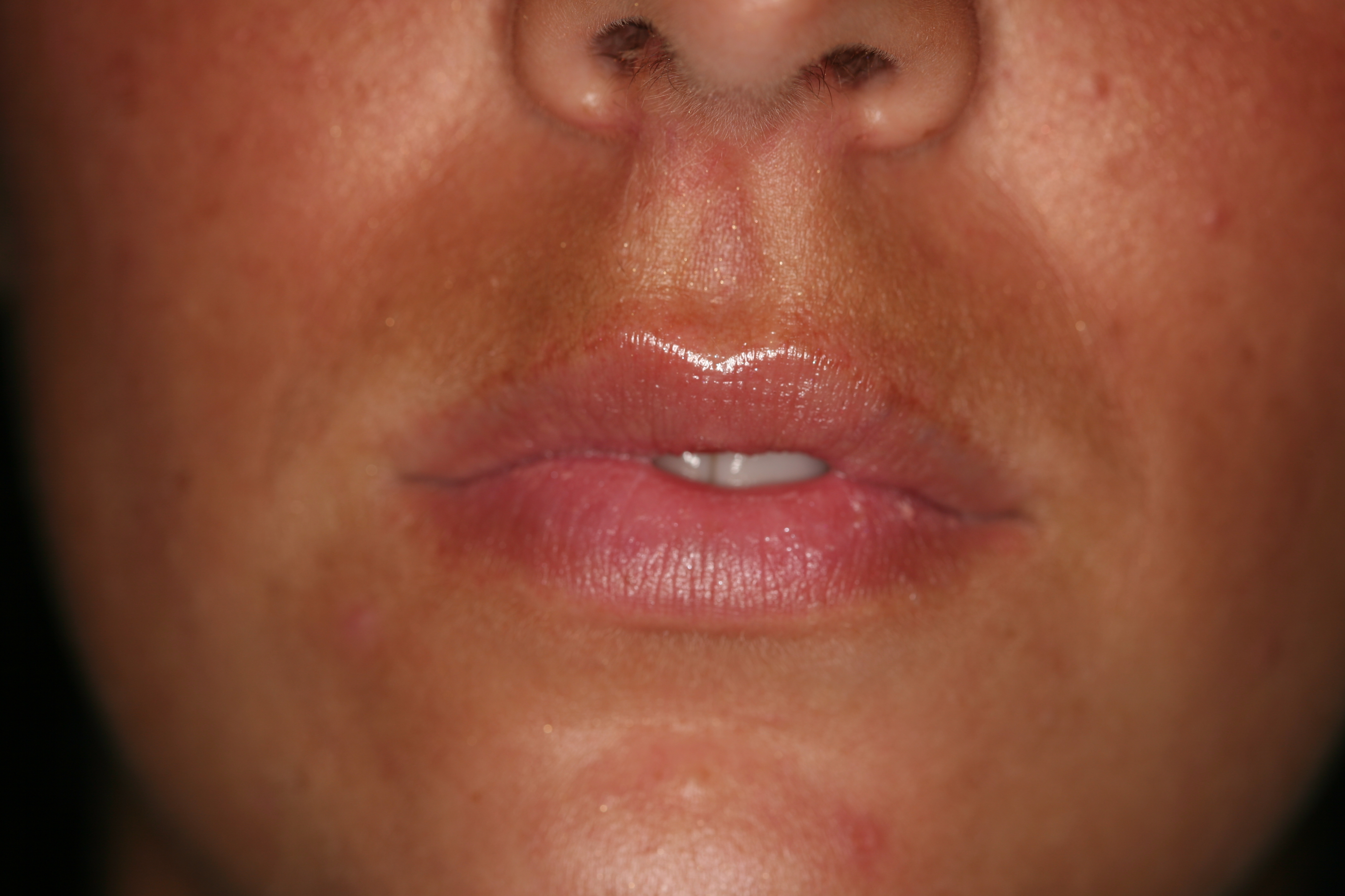 jd lip aft copy | Aesthetics Blog